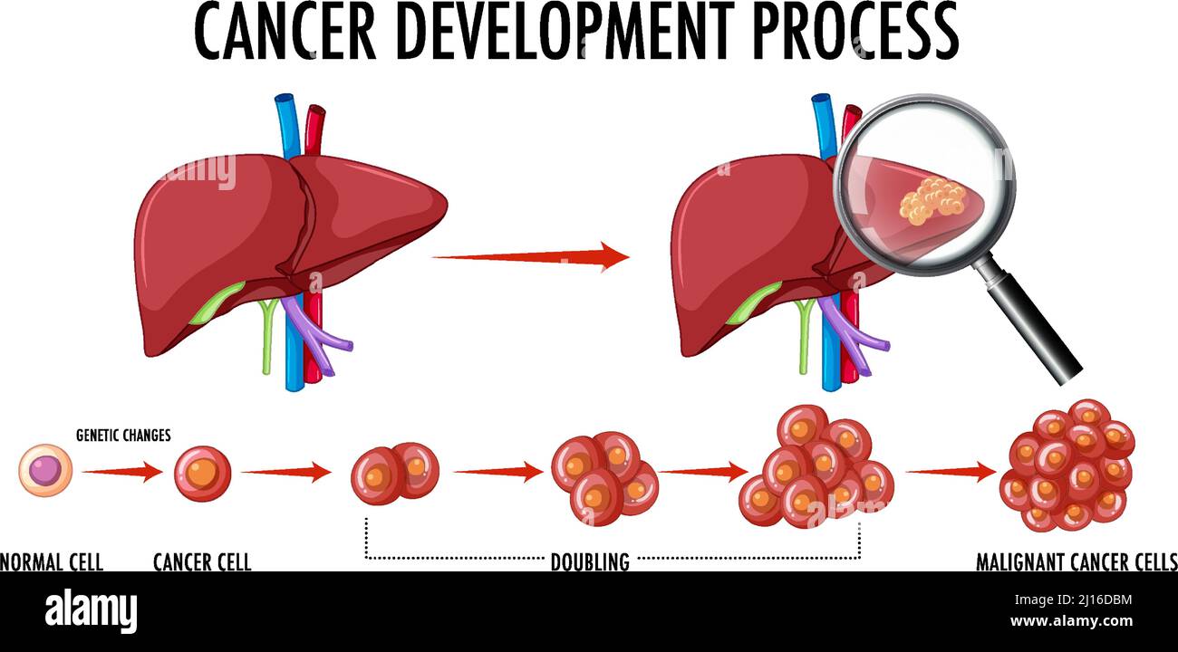 Diagram showing normal and cancer cells in human illustration Stock ...
