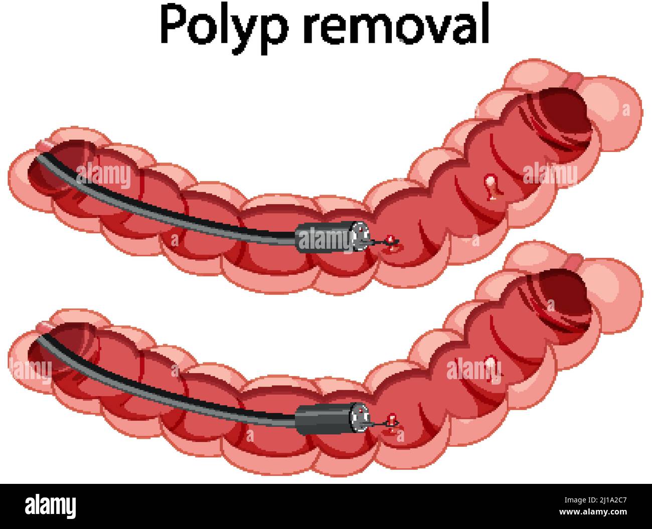 Diagram showing polyp removal illustration Stock Vector Image & Art - Alamy