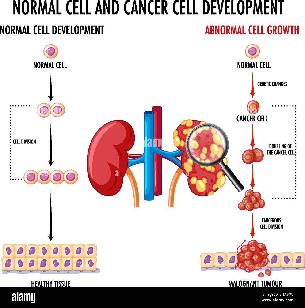 Diagram showing cancer development process illustration Stock Vector ...