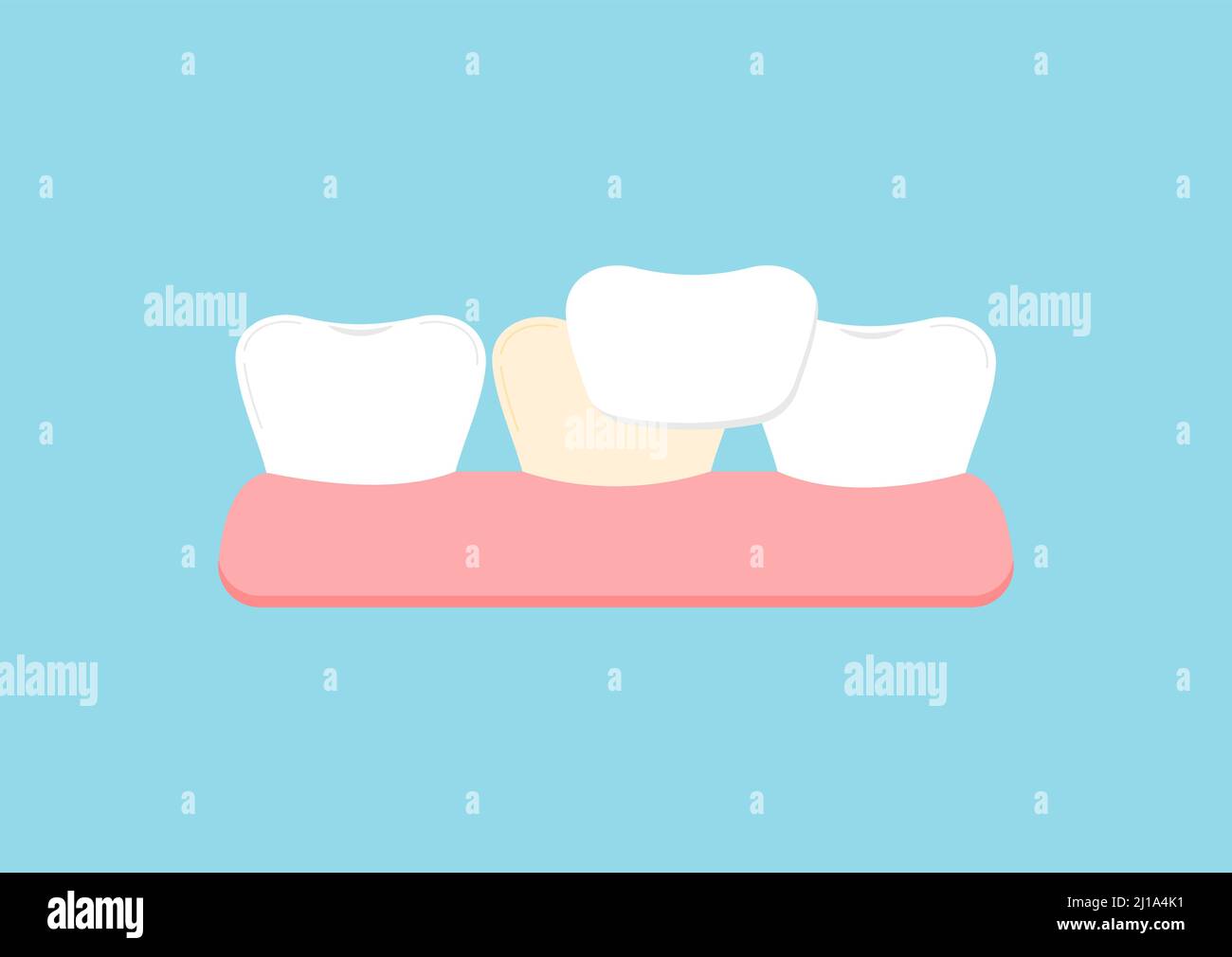 Tooth health and tooth with orthodontic veneer icon Stock Vector Image ...