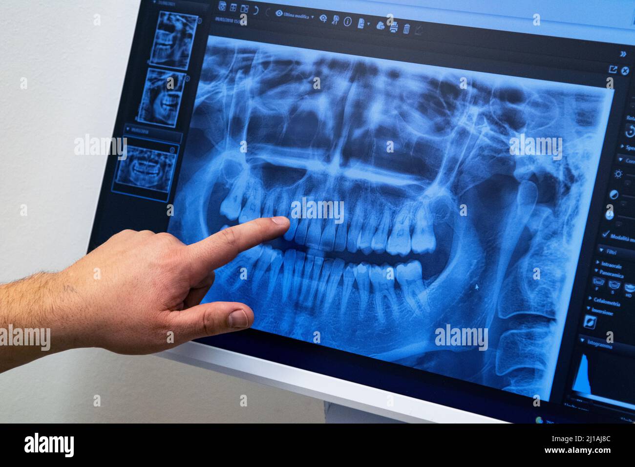 Dental overview on computer screen at a dental office Stock Photo - Alamy