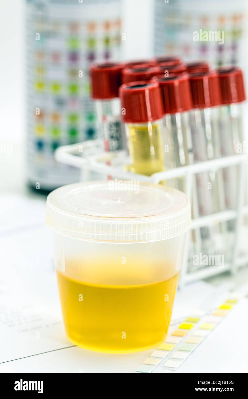 urine vial in laboratory, toxicology or routine examination Stock Photo ...