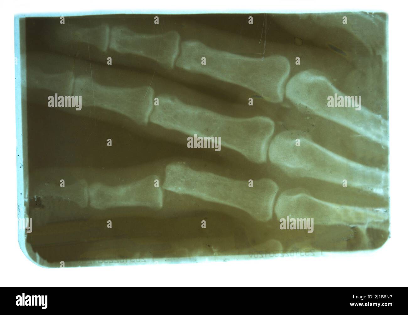 X-ray of a hand with a dislocated finger. Displaced bones Stock Photo ...