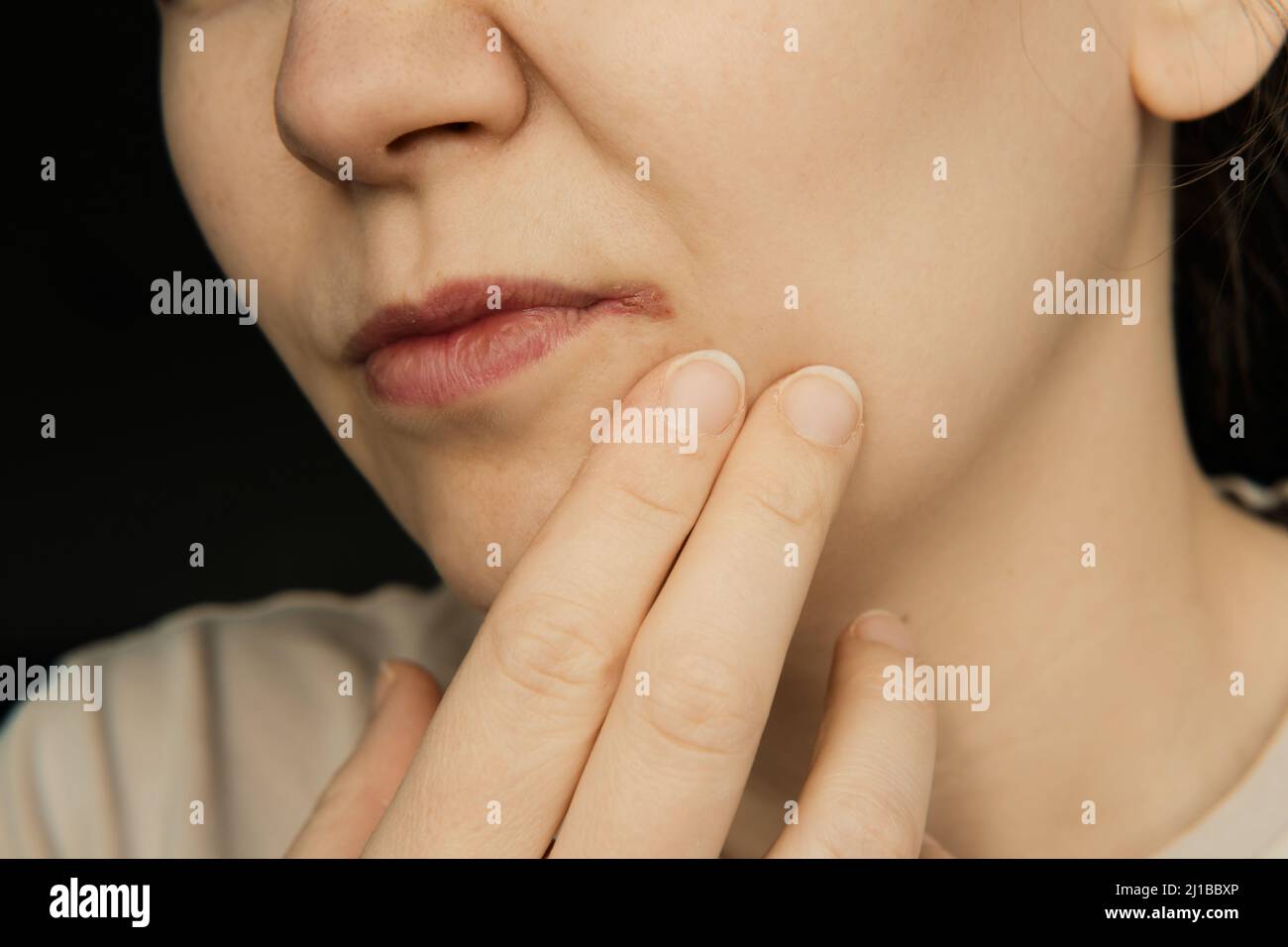 Lip herpes and Angular cheilitis on womans face. Beauty skin female ...