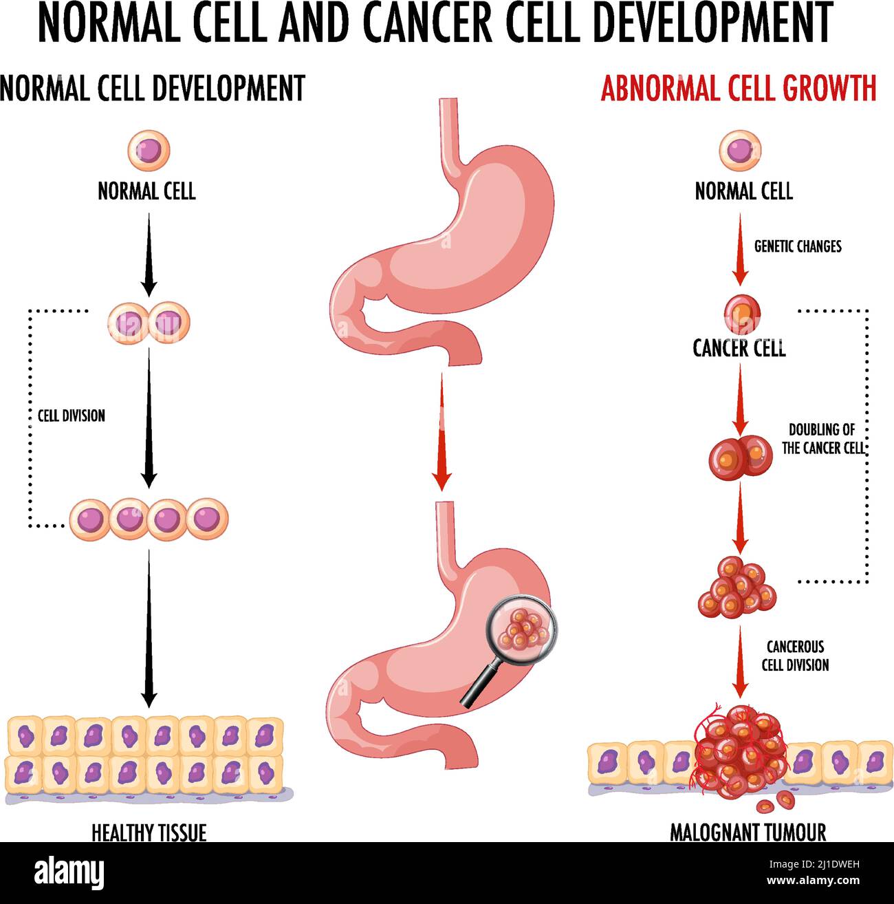 Diagram showing normal and cancer cell illustration Stock Vector Image ...