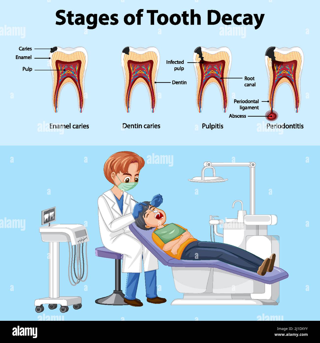 Poster stages of tooth decay with dentist man examining patient teeth ...