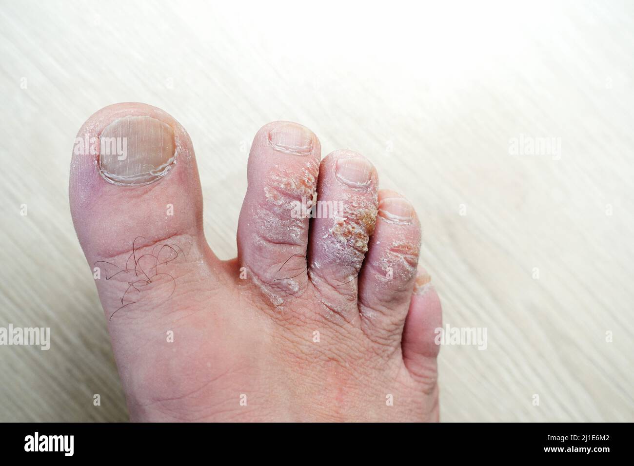Person calluses on toes scratches hi-res stock photography and images ...