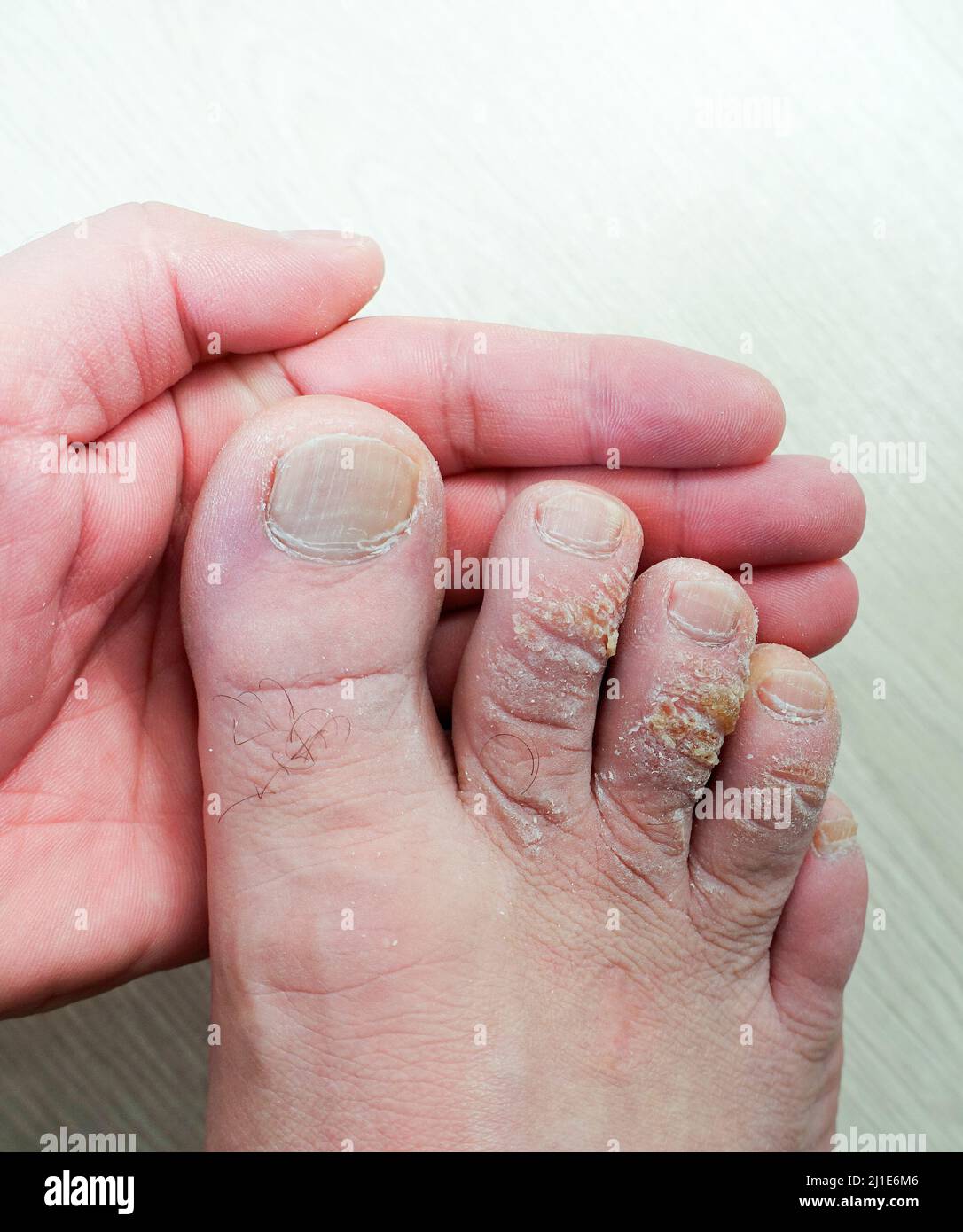 Fungal calluses hi-res stock photography and images - Alamy