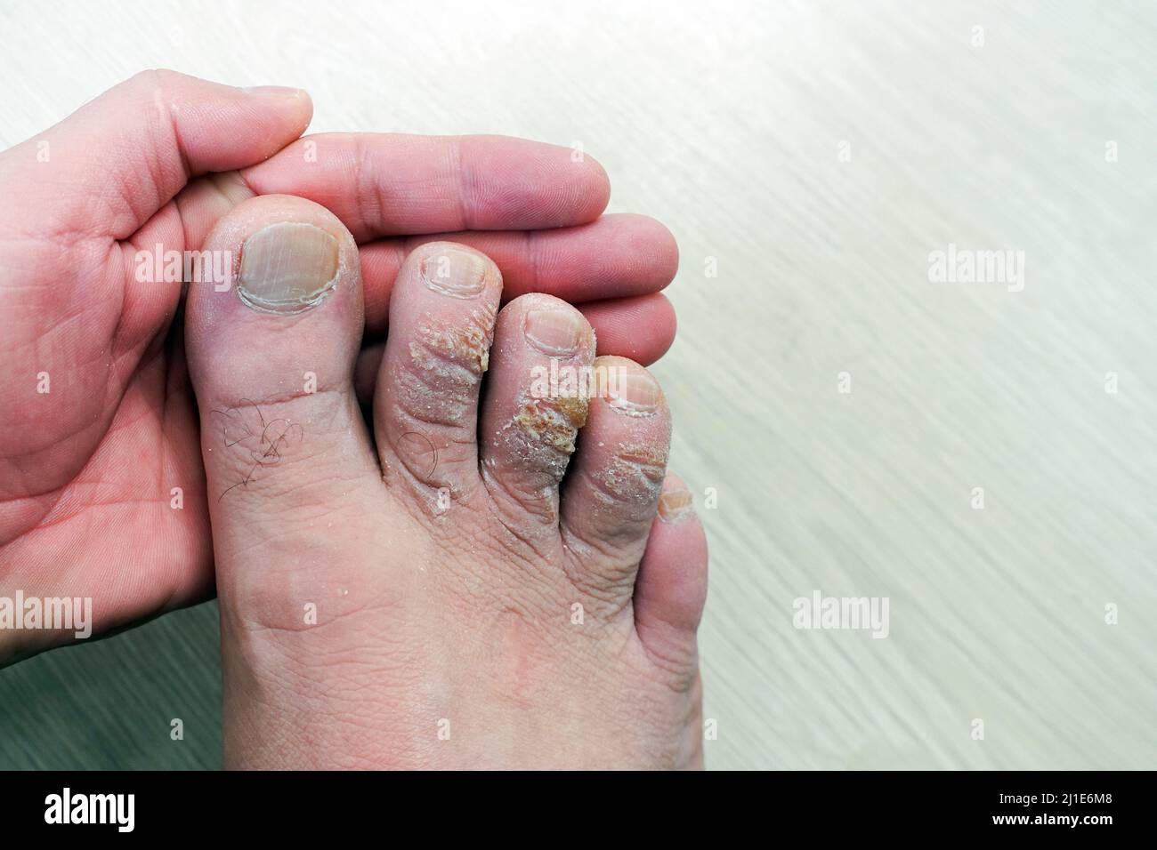 close-up foot skin diseases, callus formation on the fingers, calluses ...