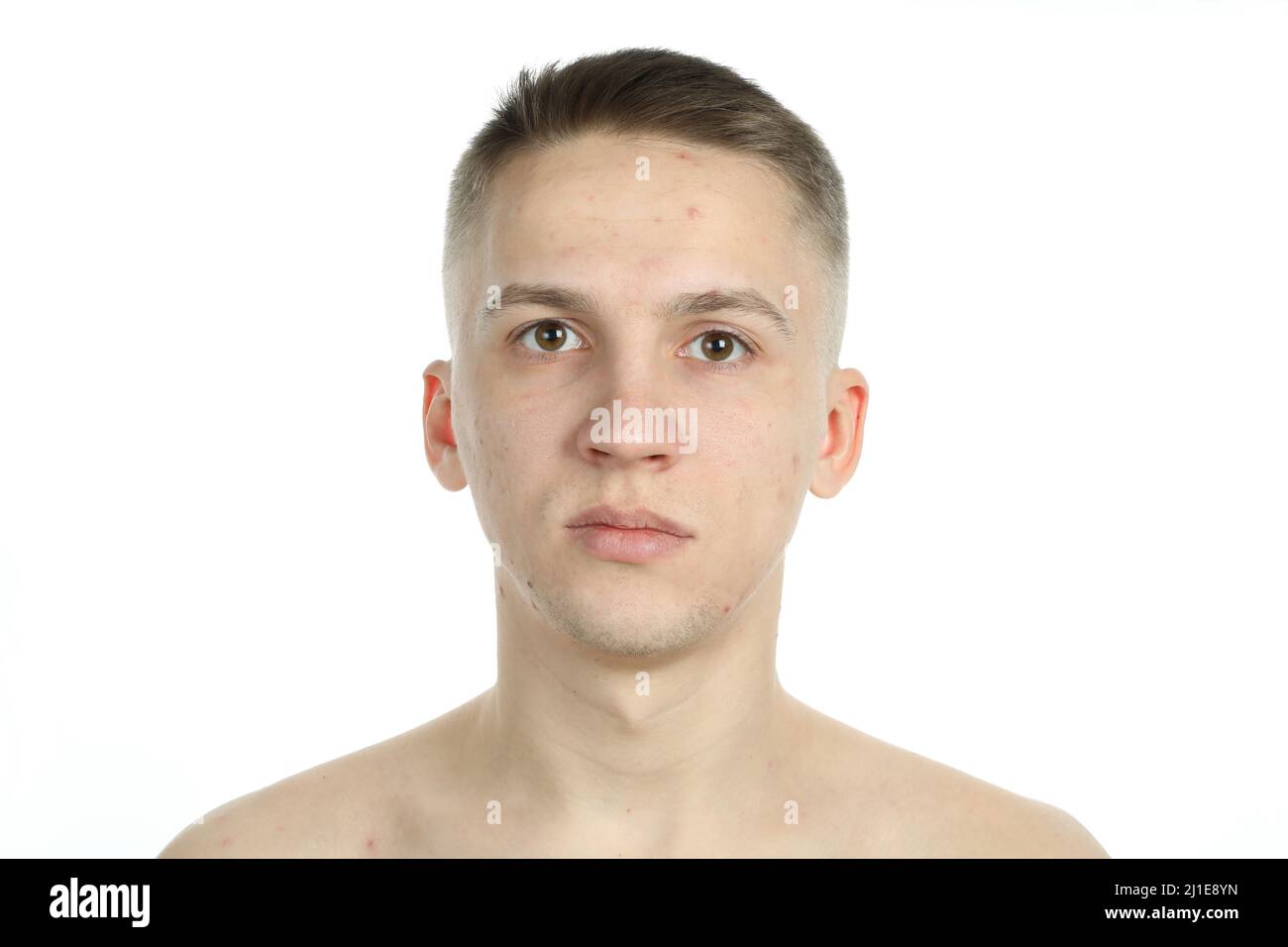 Young man with problem face skin isolated on white background Stock ...
