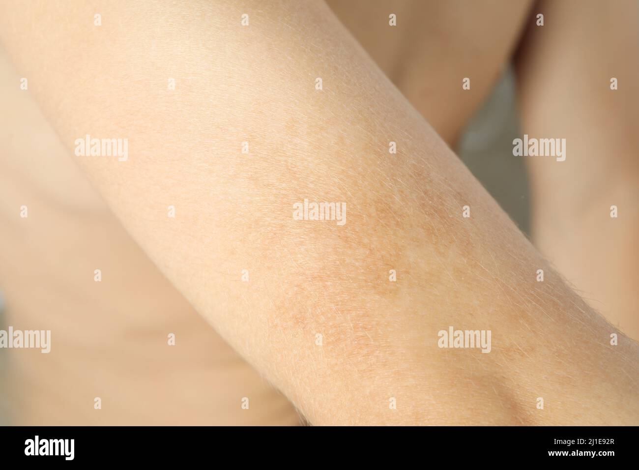 Concept of skin care, hand of young man with brown spots Stock Photo ...