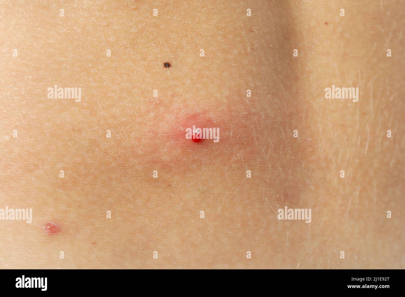 Skin cancer melanoma medical concept hi-res stock photography and ...