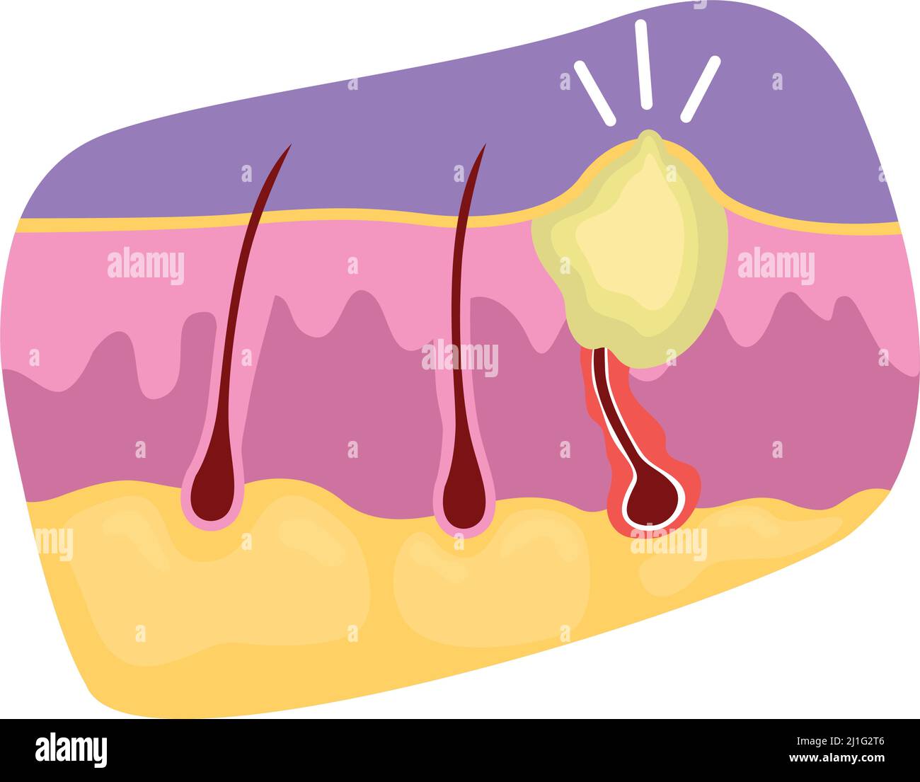 Ingrown Hair Diagram