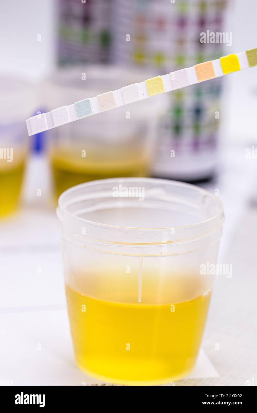 reagent strips used in urinalysis to analyze Leukocytes, Urobilinogen ...