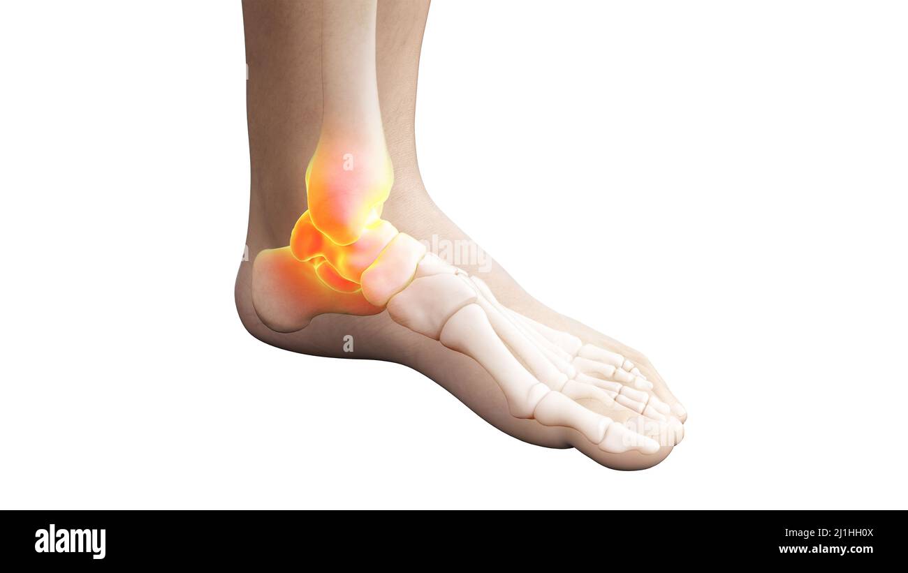Painful ankle joint, illustration Stock Photo - Alamy