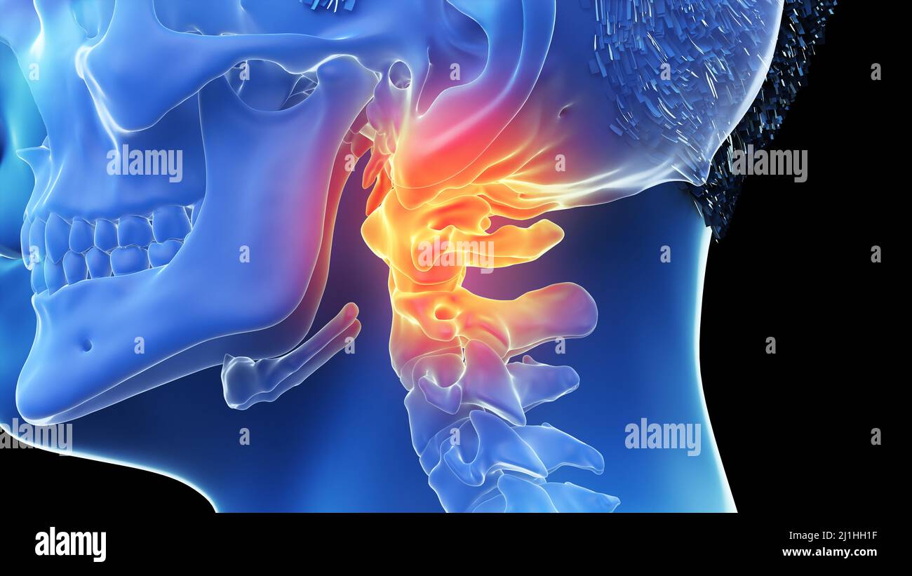 Painful atlas bone, illustration Stock Photo - Alamy