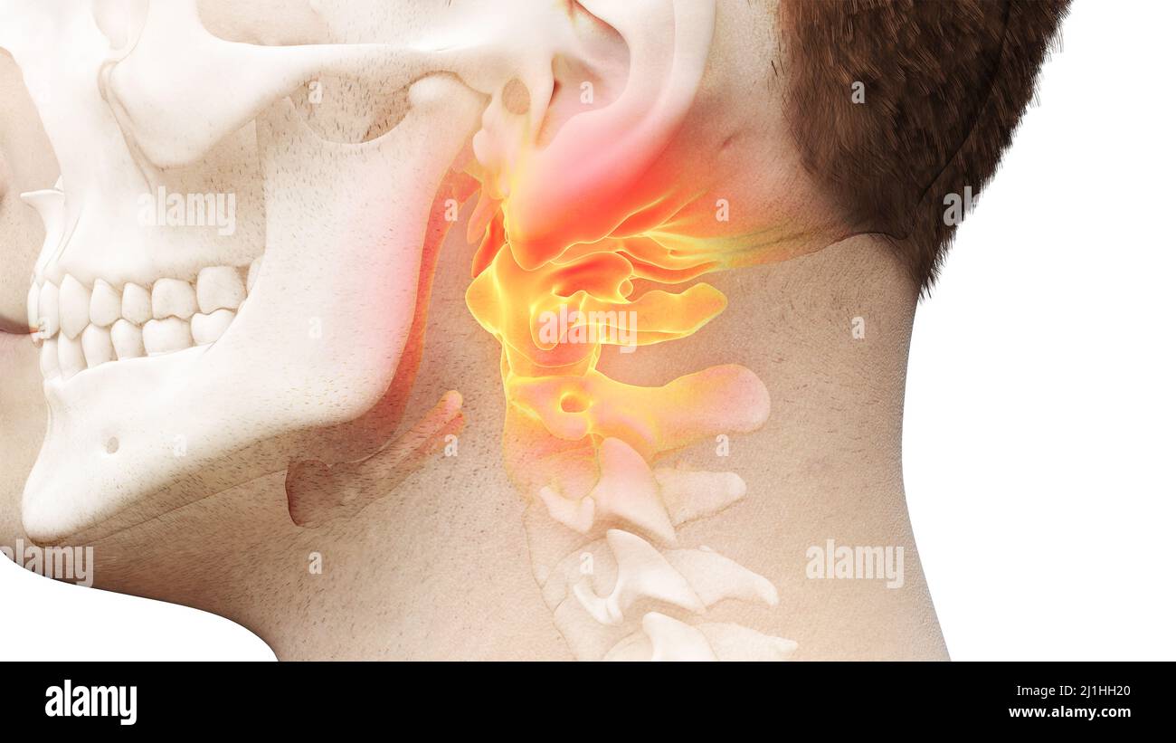 Painful atlas bone, illustration Stock Photo - Alamy
