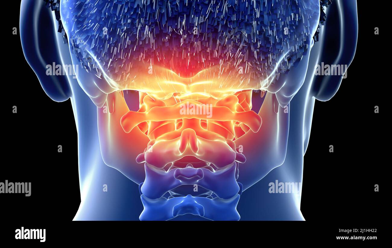 Painful atlas bone, illustration Stock Photo - Alamy