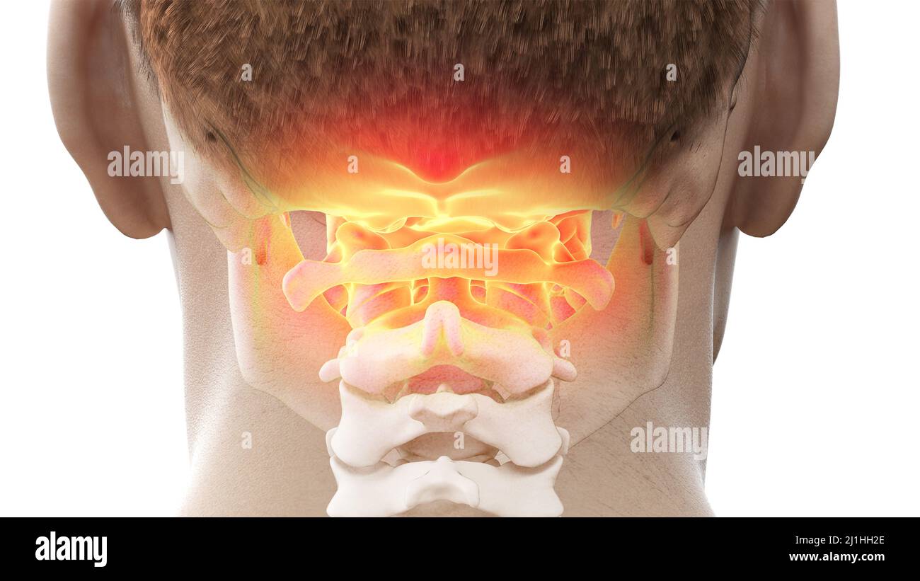 Painful atlas bone, illustration Stock Photo - Alamy