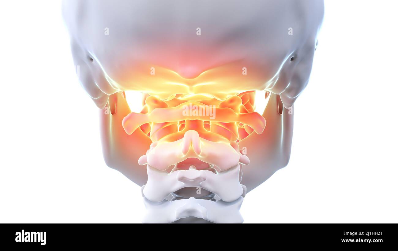 Painful atlas bone, illustration Stock Photo - Alamy