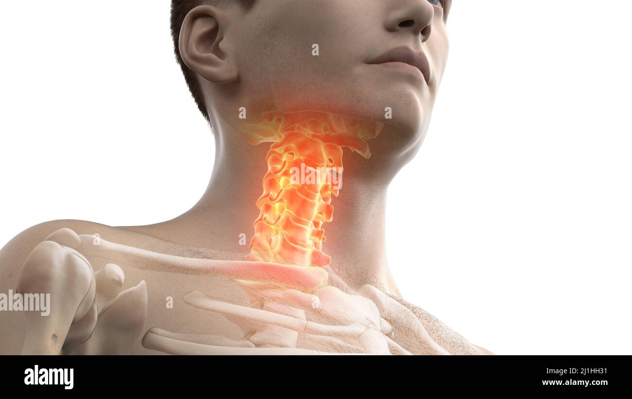 Painful cervical spine, illustration Stock Photo - Alamy