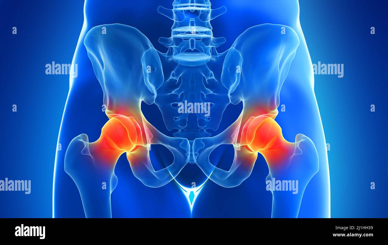 Painful hip joints, illustration Stock Photo - Alamy