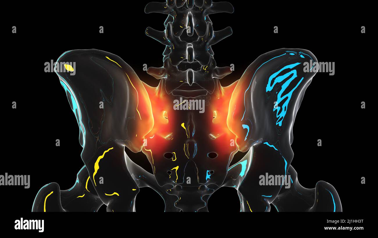 Painful sacroiliac joint, illustration Stock Photo - Alamy