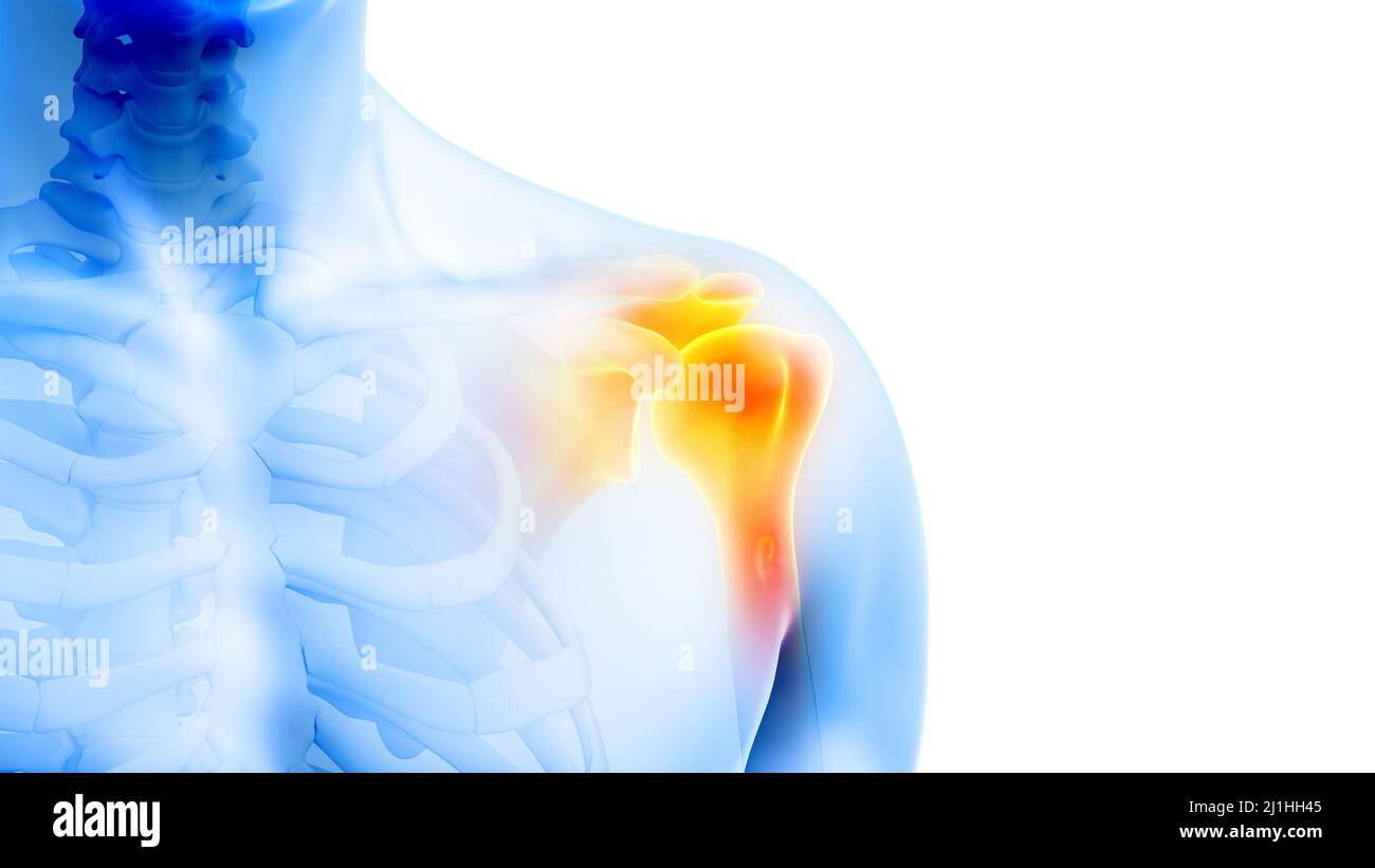 Painful shoulder, illustration Stock Photo - Alamy