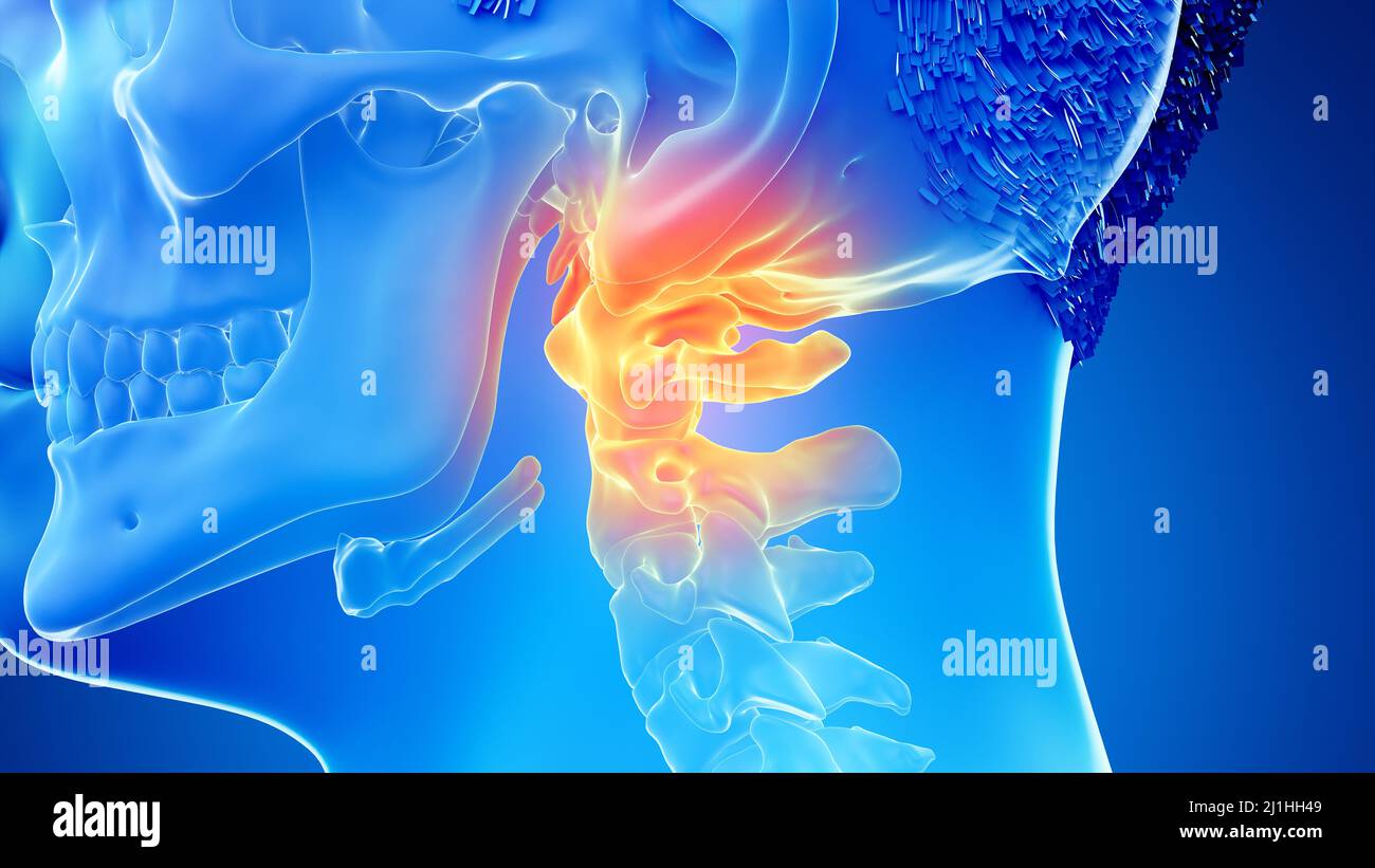 Painful atlas bone, illustration Stock Photo - Alamy
