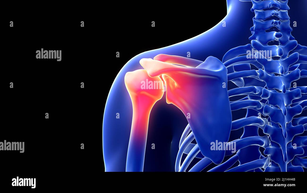 Painful shoulder, illustration Stock Photo - Alamy