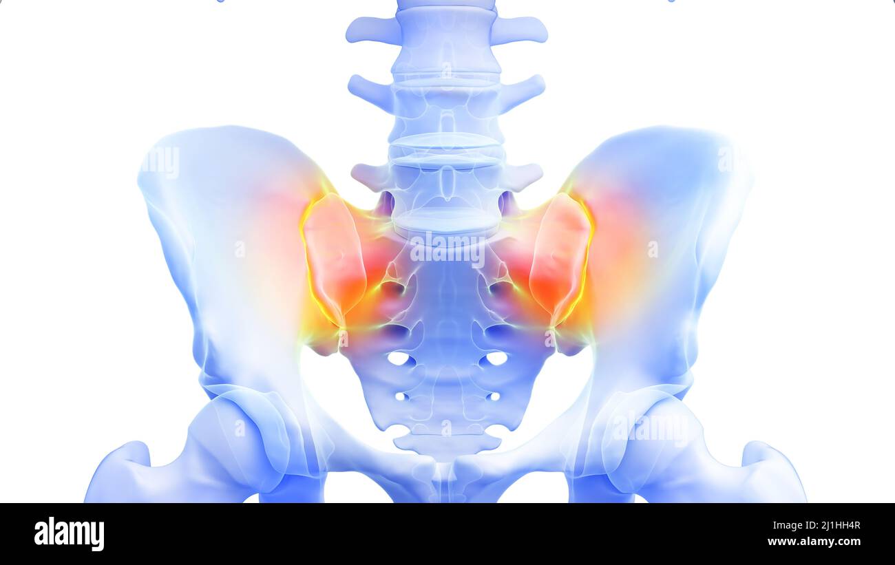 Painful sacroiliac joint, illustration Stock Photo - Alamy