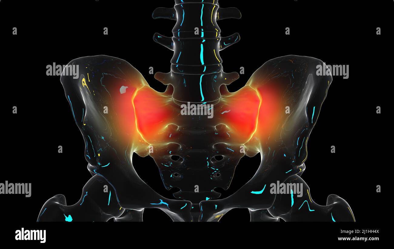 Painful sacroiliac joint, illustration Stock Photo - Alamy