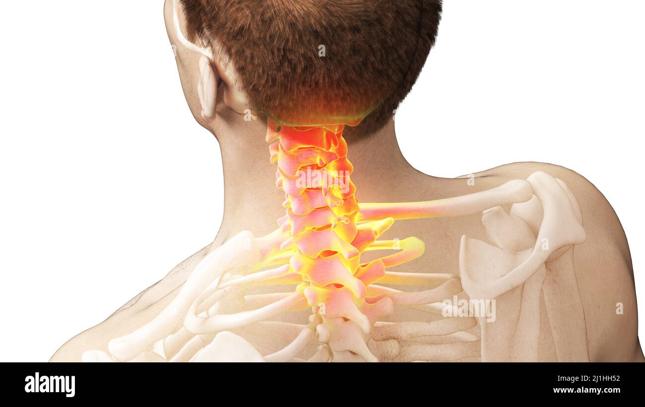 Painful cervical spine, illustration Stock Photo - Alamy
