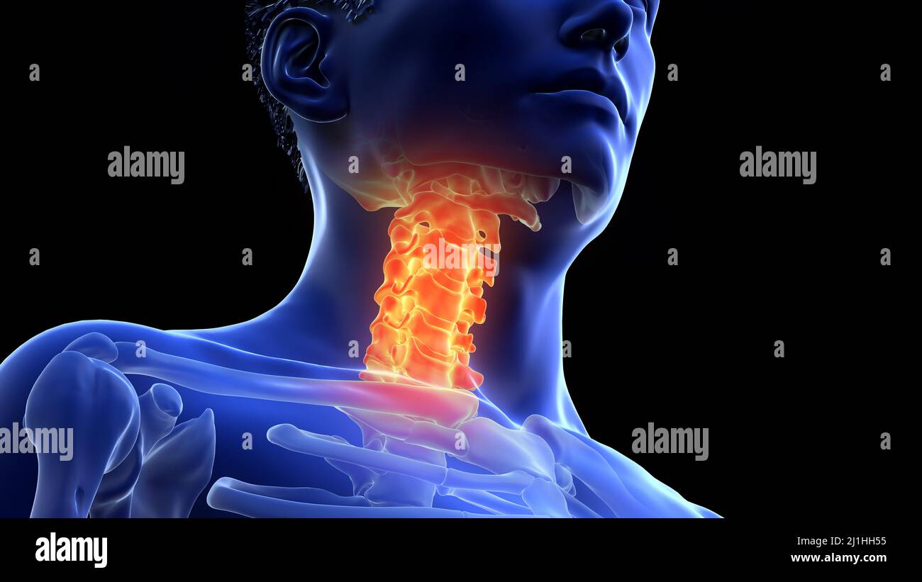 Painful cervical spine, illustration Stock Photo - Alamy
