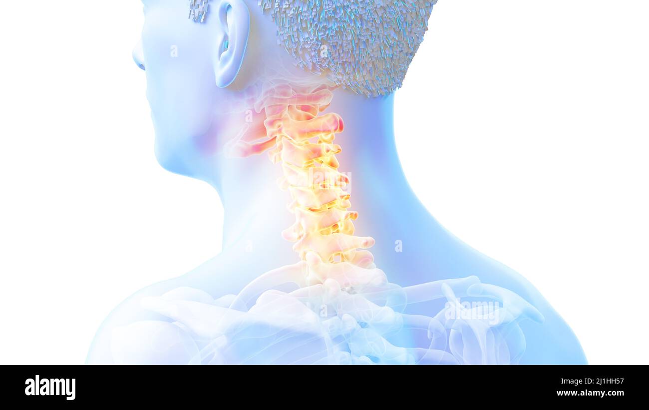 Painful cervical spine, illustration Stock Photo - Alamy