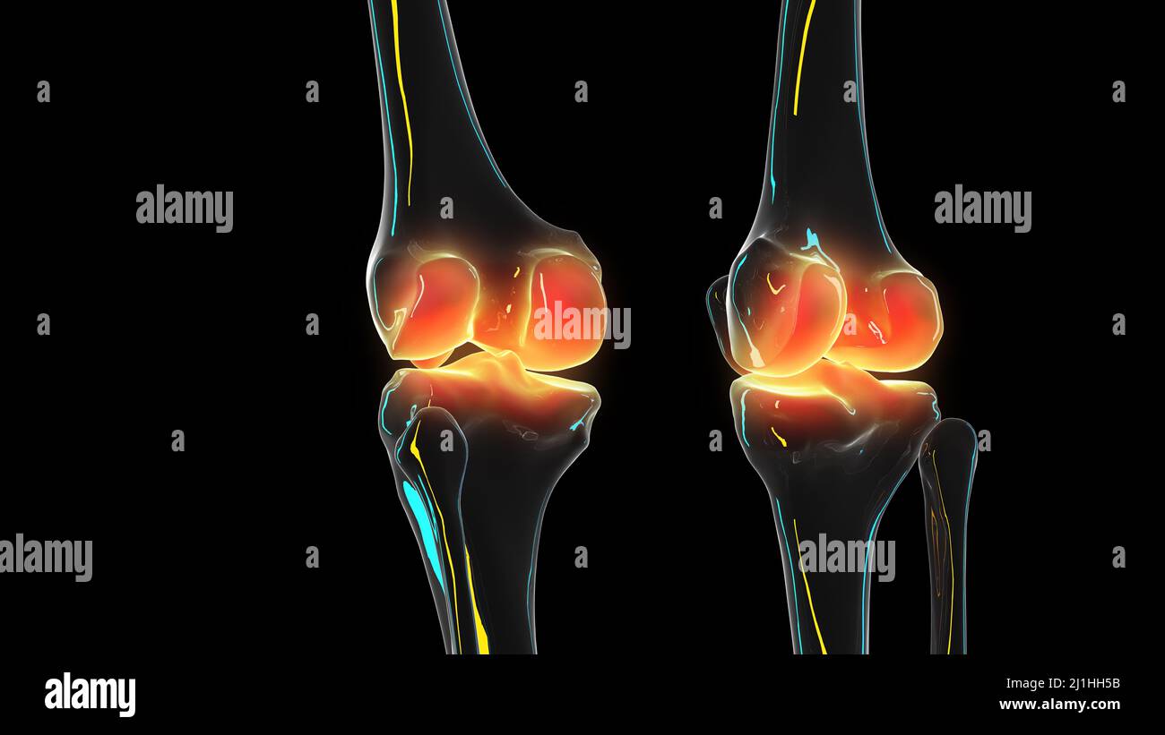 Painful knee joints, illustration Stock Photo - Alamy