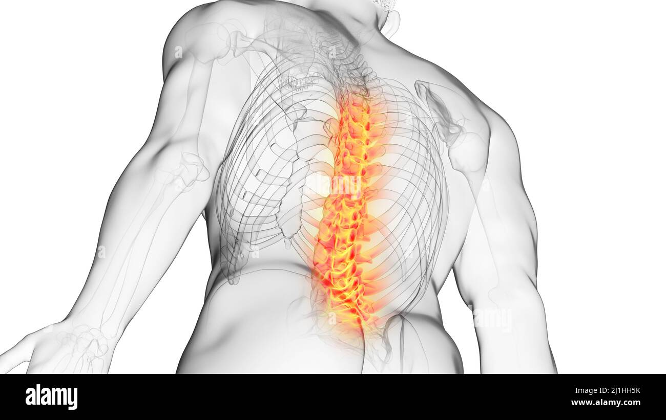 Painful spine, illustration Stock Photo - Alamy