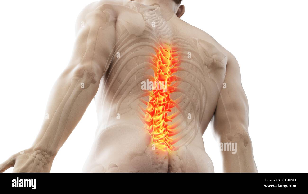 Painful spine, illustration Stock Photo - Alamy