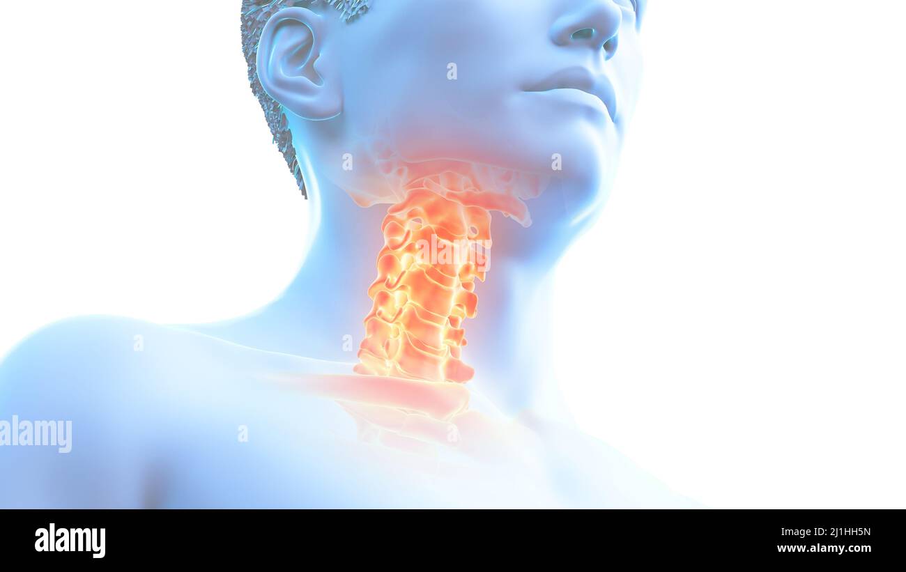 Painful cervical spine, illustration Stock Photo - Alamy