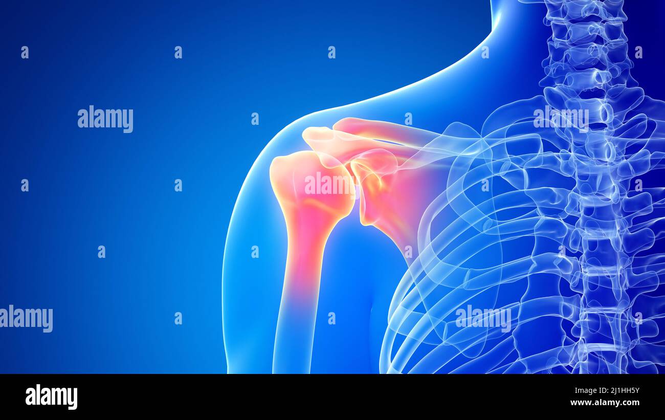 Painful shoulder, illustration Stock Photo - Alamy