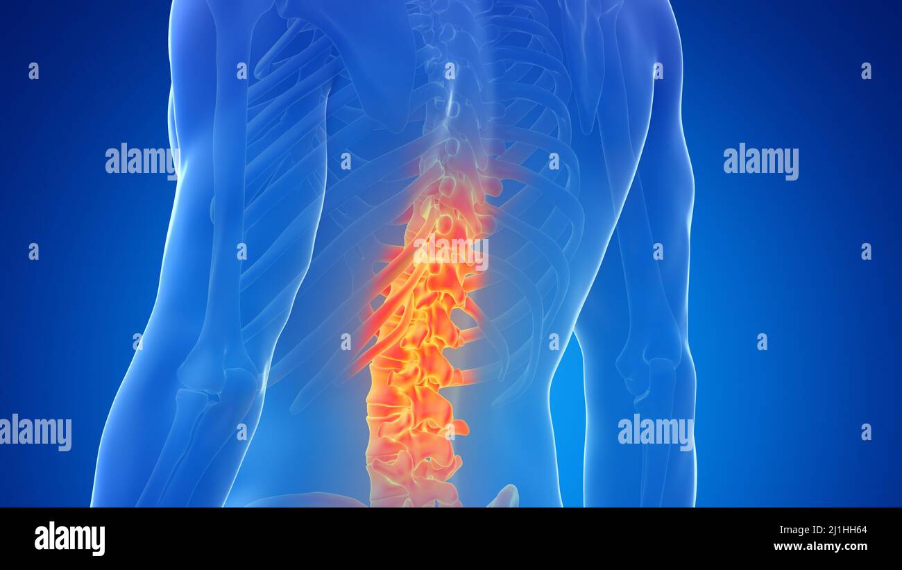 Painful spine, illustration Stock Photo - Alamy