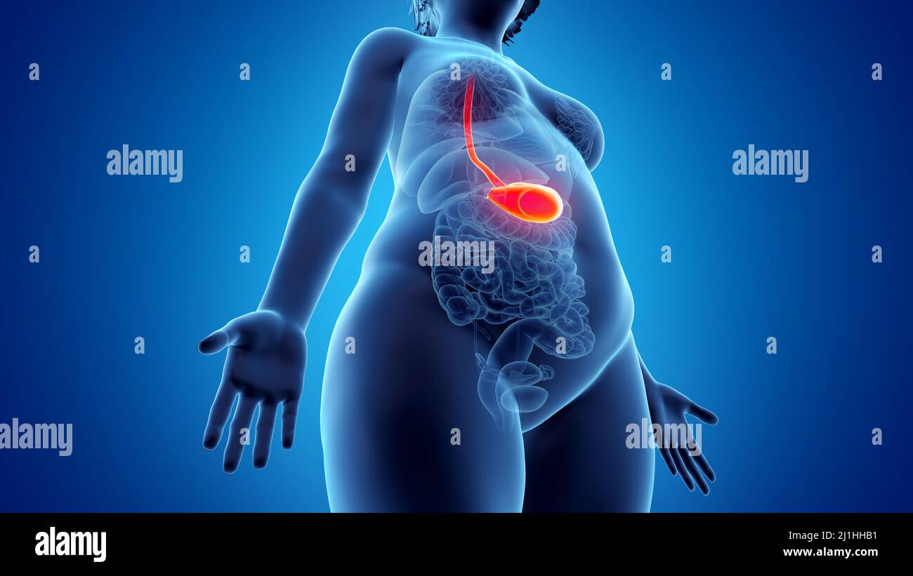 Obese woman's stomach, illustration Stock Photo - Alamy