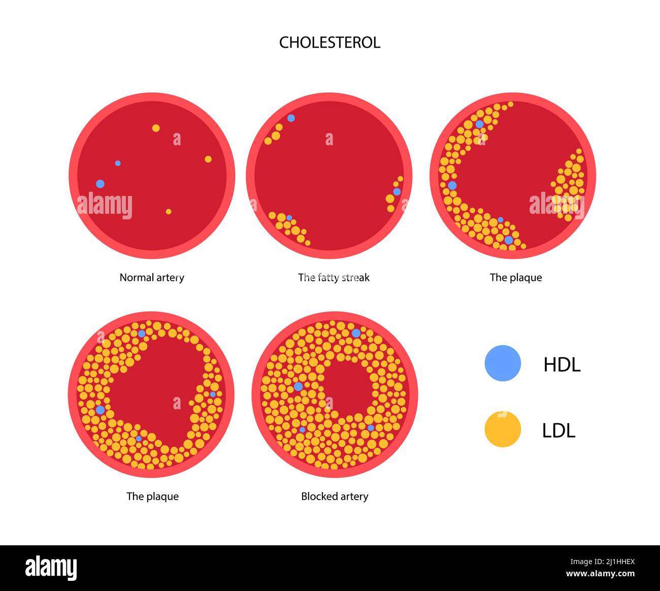 Cholesterol in human blood vessels, illustration Stock Photo - Alamy