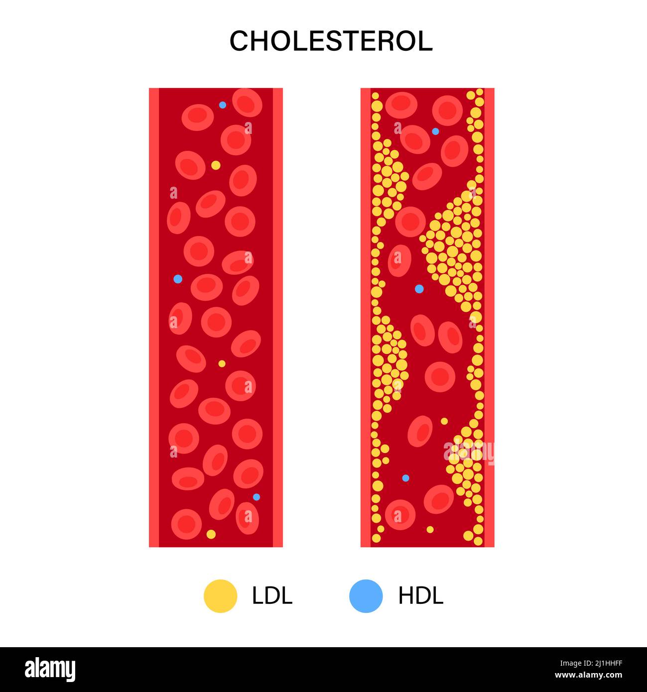 Cholesterol in human blood vessels, illustration Stock Photo - Alamy