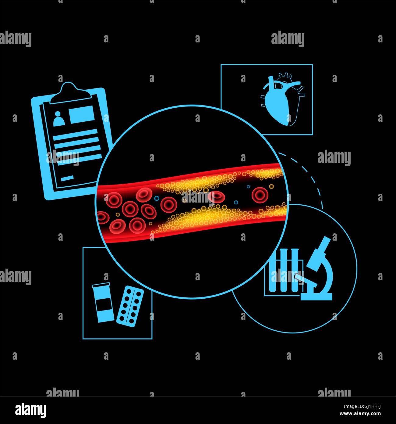 Cholesterol in human blood vessels, illustration Stock Photo - Alamy