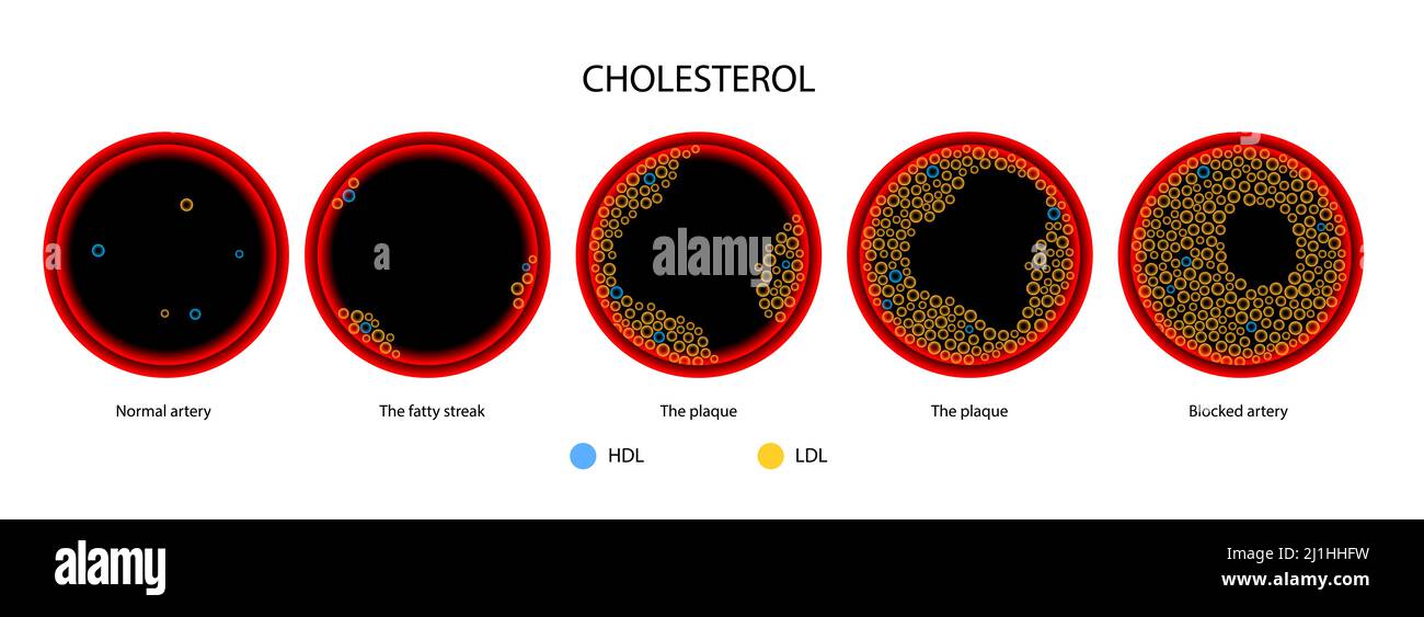 Cholesterol in human blood vessels, illustration Stock Photo - Alamy