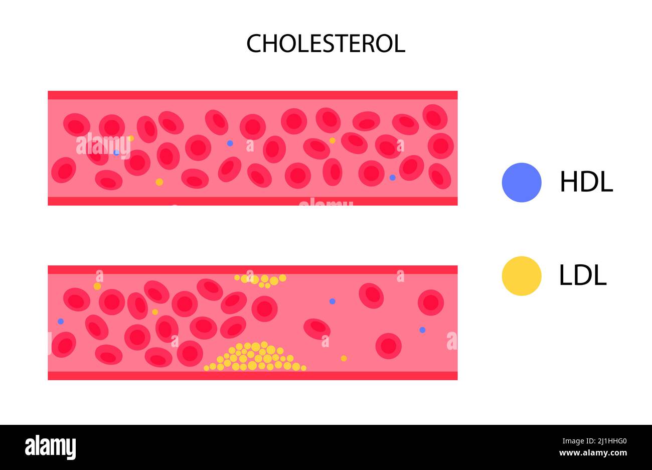 Cholesterol in human blood vessels, illustration Stock Photo - Alamy