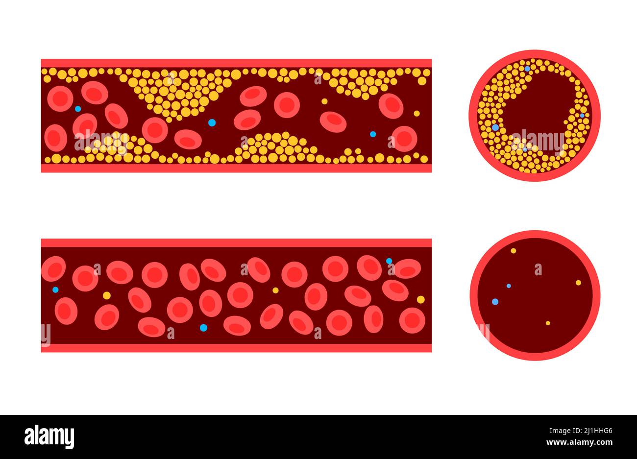 Cholesterol In Human Blood Vessels Illustration Stock Photo Alamy