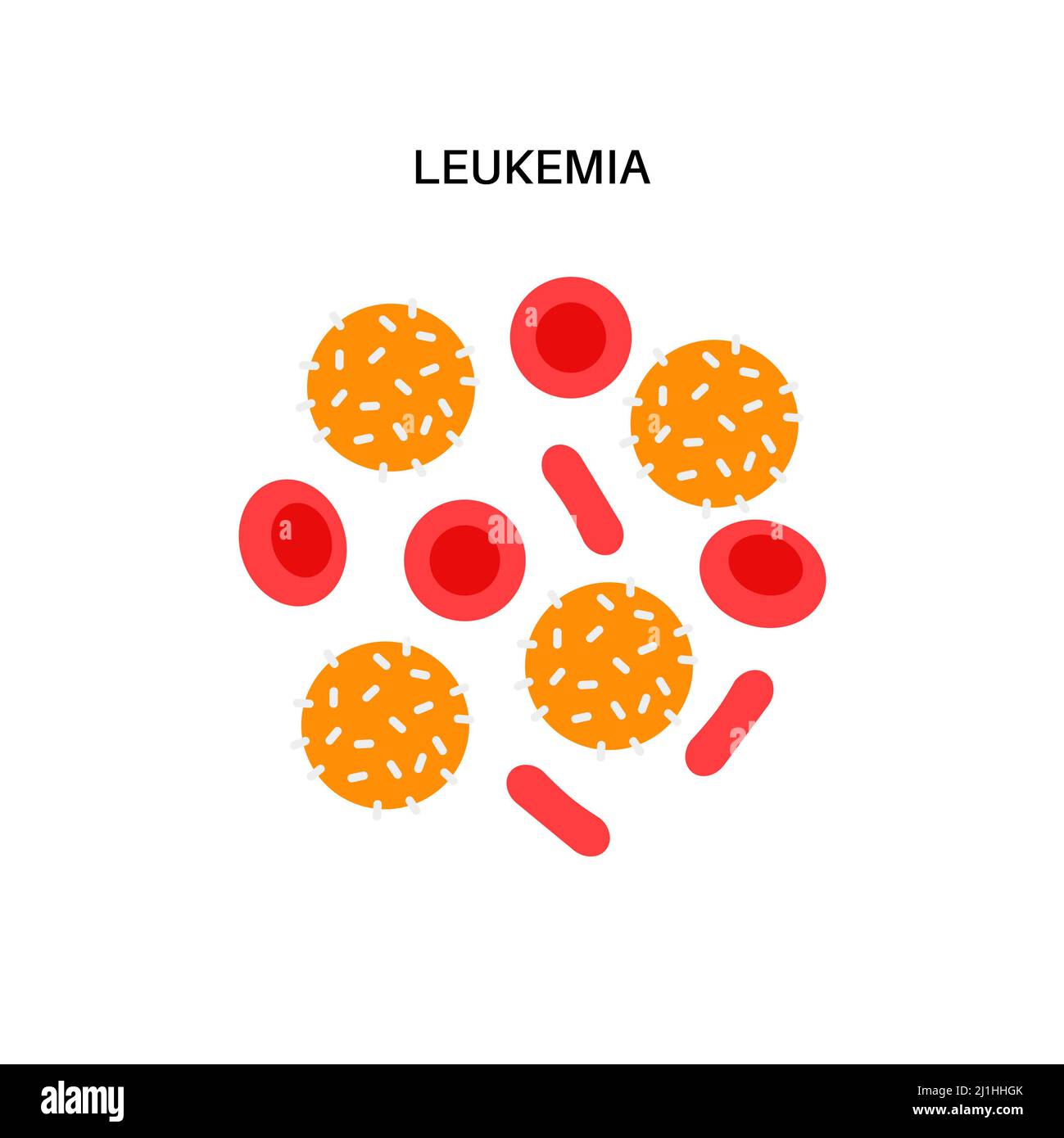 Chronic myeloid leukaemia hi-res stock photography and images - Alamy