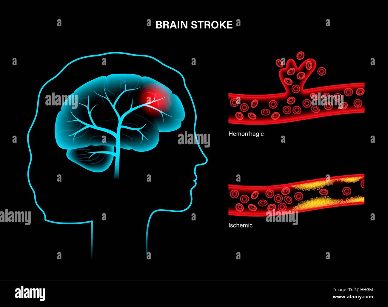 Ischaemic and haemorrhagic strokes, illustration Stock Photo - Alamy